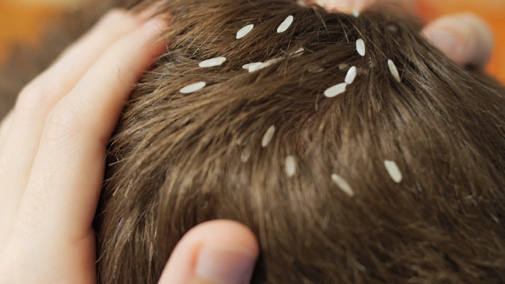 'Super lice' in Wisconsin not responding to typical treatments | WMSN